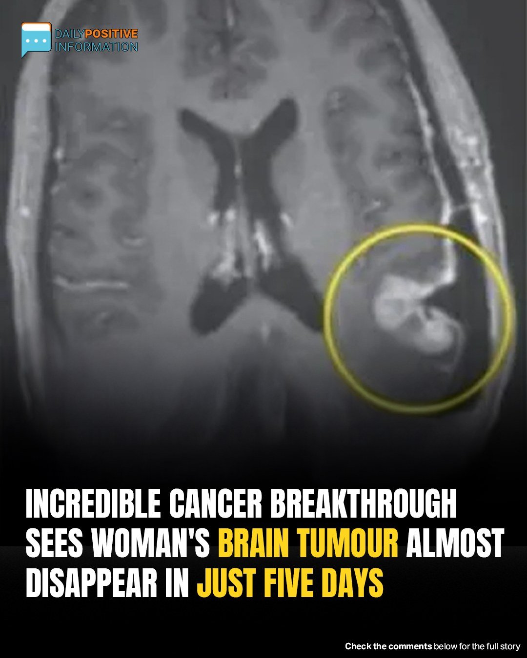 Woman’s Inoperable Brain Tumor Shrinks In Just Five Days Thanks To ...